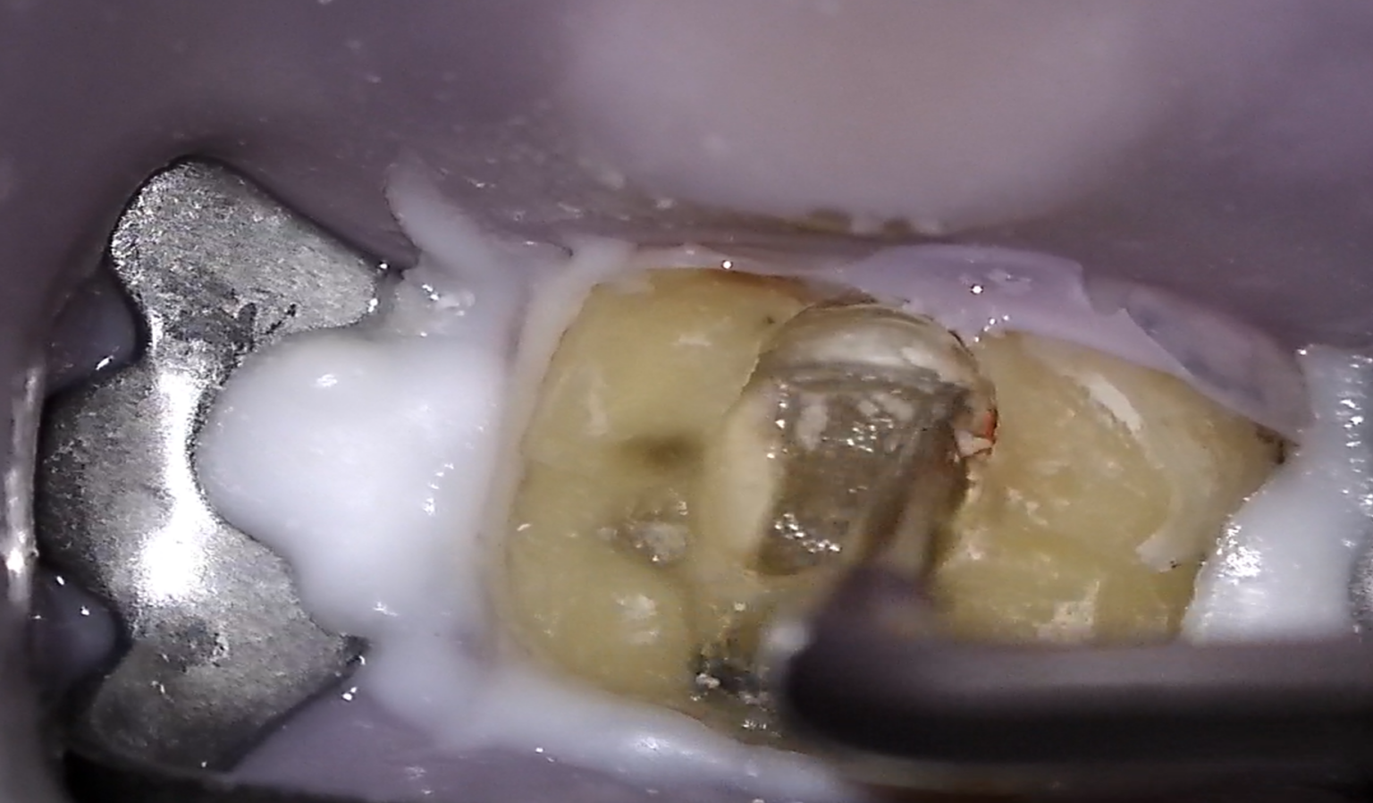 Clinical Tips for Managing Calcified Canals – endoville.com