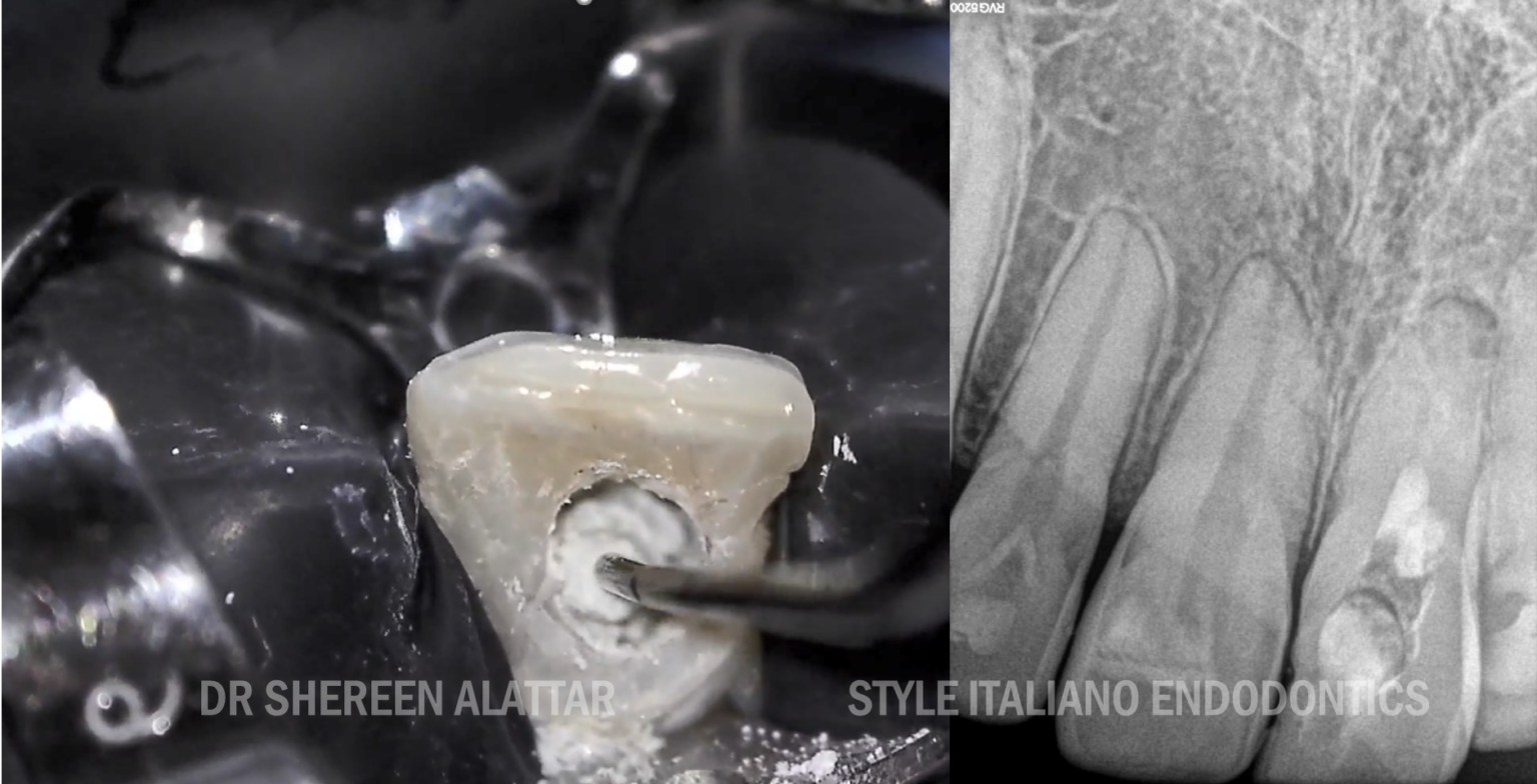 Root perforations: from breakdown to breakthrough – endoville.com