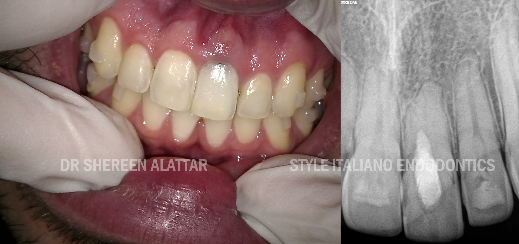 Root perforations: from breakdown to breakthrough – endoville.com