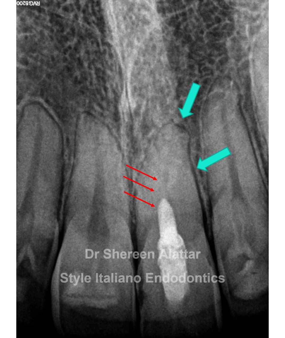 Root perforations: from breakdown to breakthrough – endoville.com
