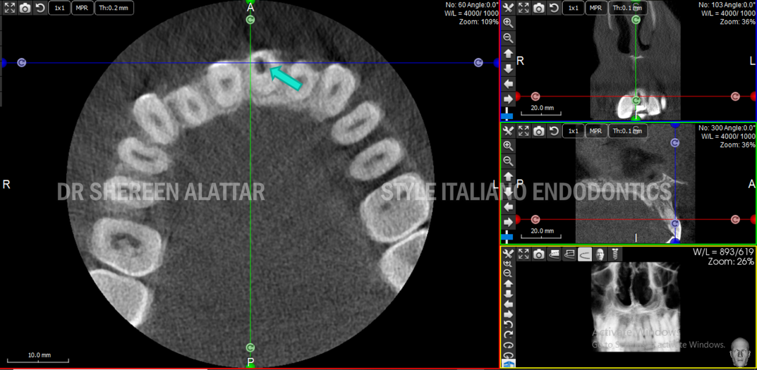 Root perforations: from breakdown to breakthrough – endoville.com