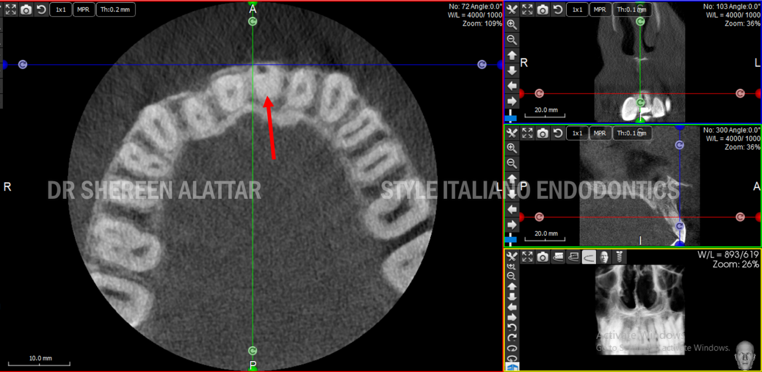 Root perforations: from breakdown to breakthrough – endoville.com