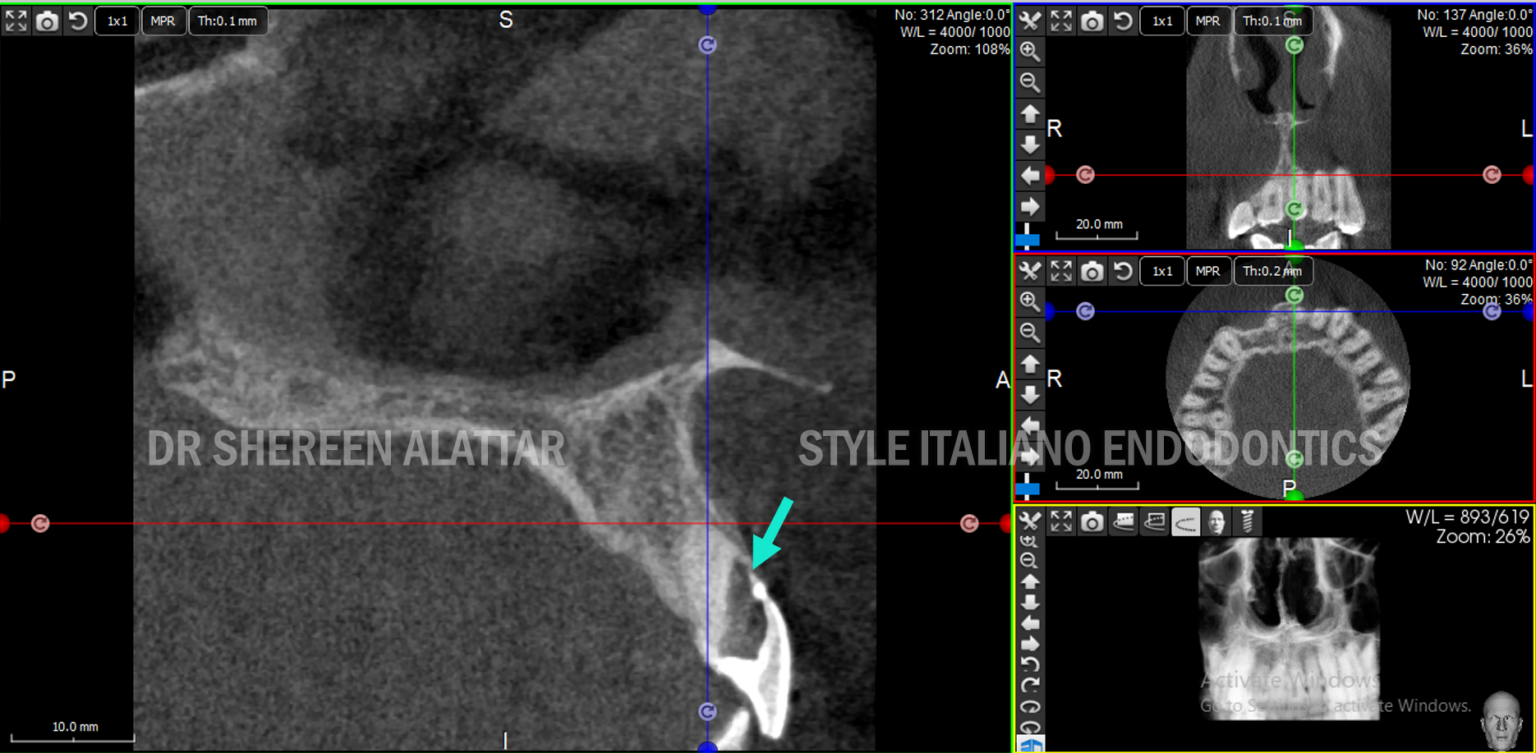 Root perforations: from breakdown to breakthrough – endoville.com