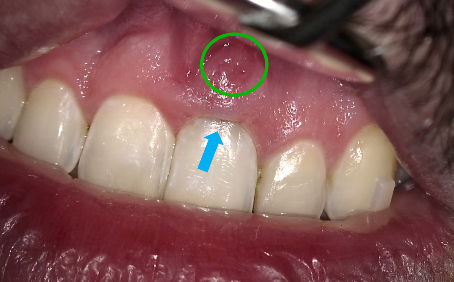 Root perforations: from breakdown to breakthrough – endoville.com