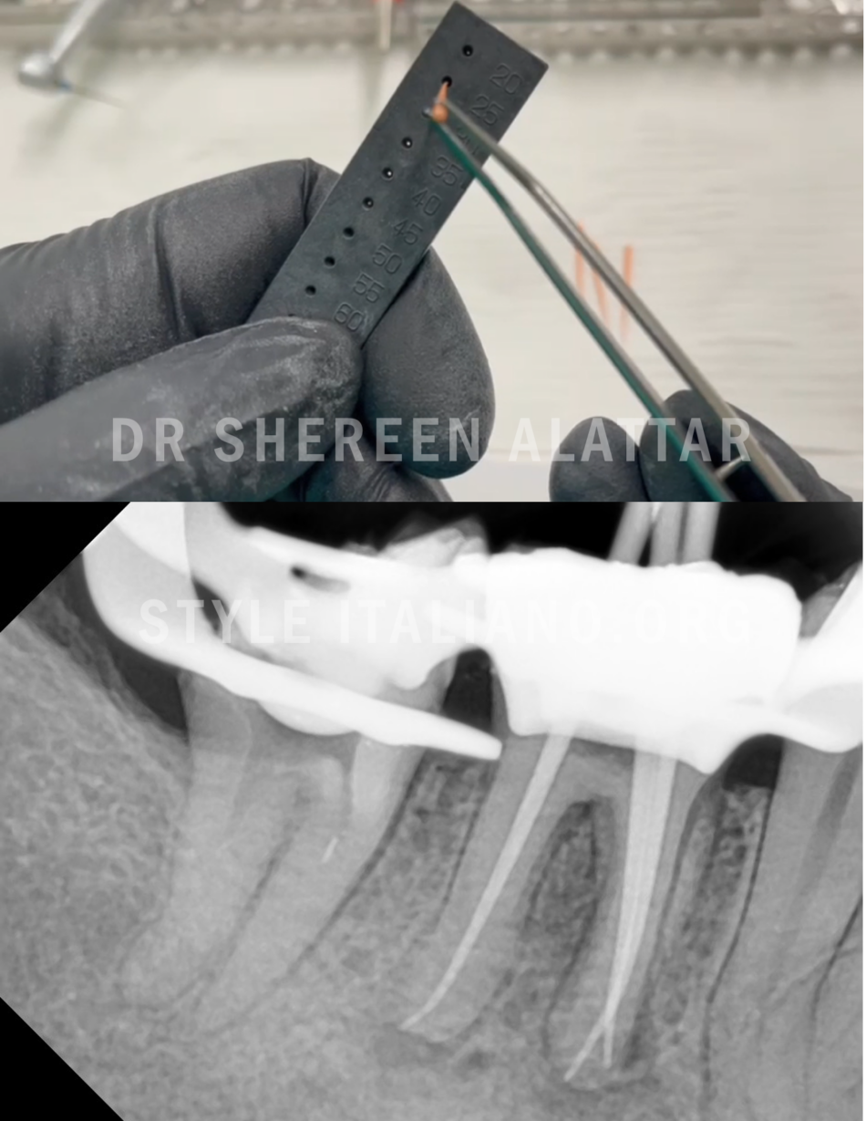 Clinical Tips for Managing Calcified Canals – endoville.com