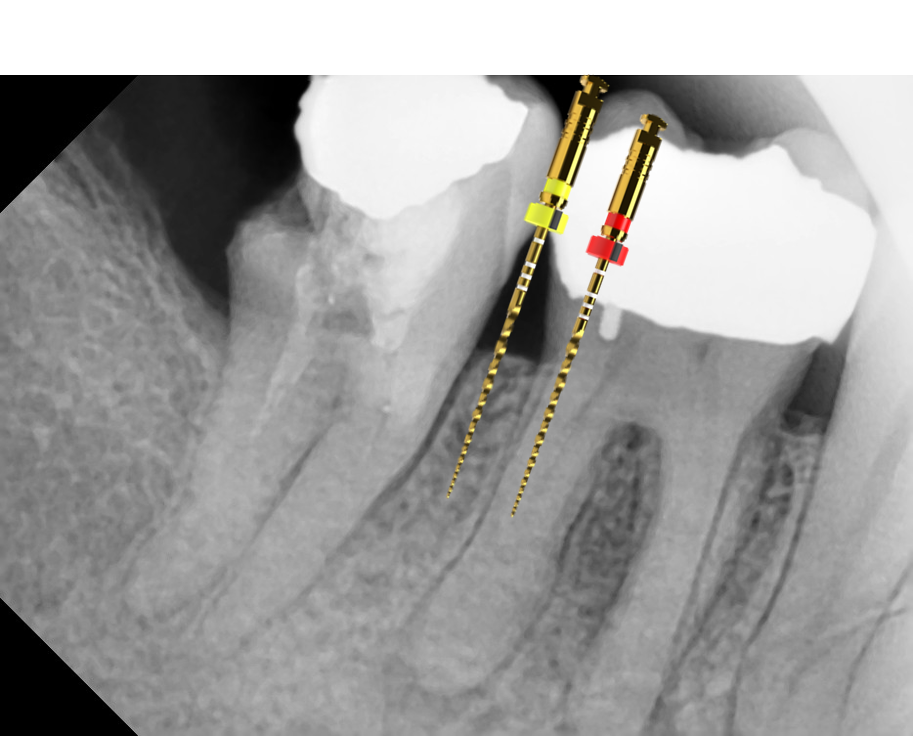 Clinical Tips for Managing Calcified Canals – endoville.com