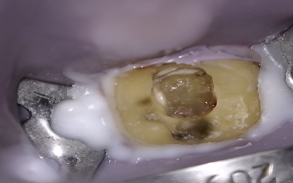 Clinical Tips for Managing Calcified Canals – endoville.com