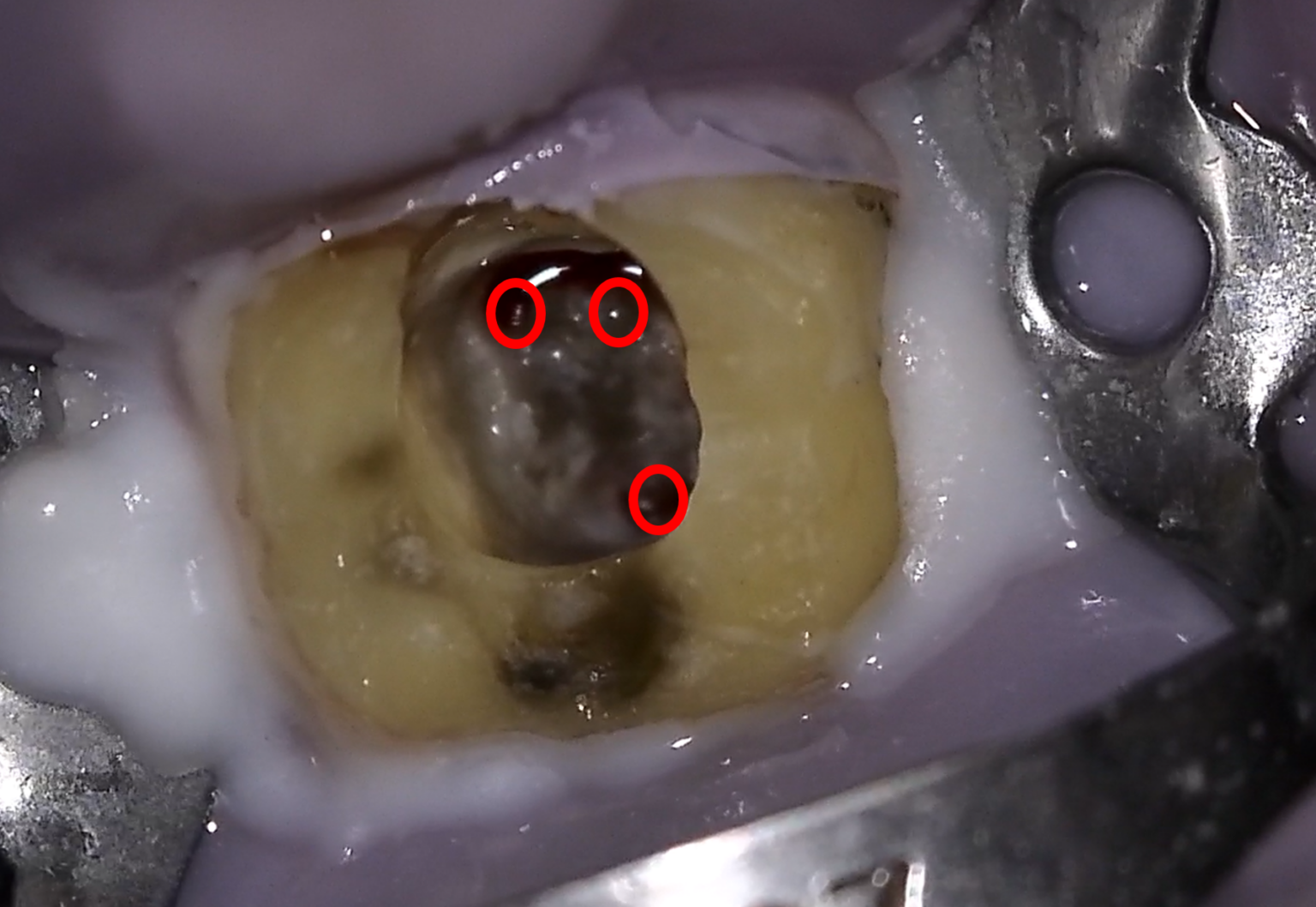Clinical Tips for Managing Calcified Canals – endoville.com