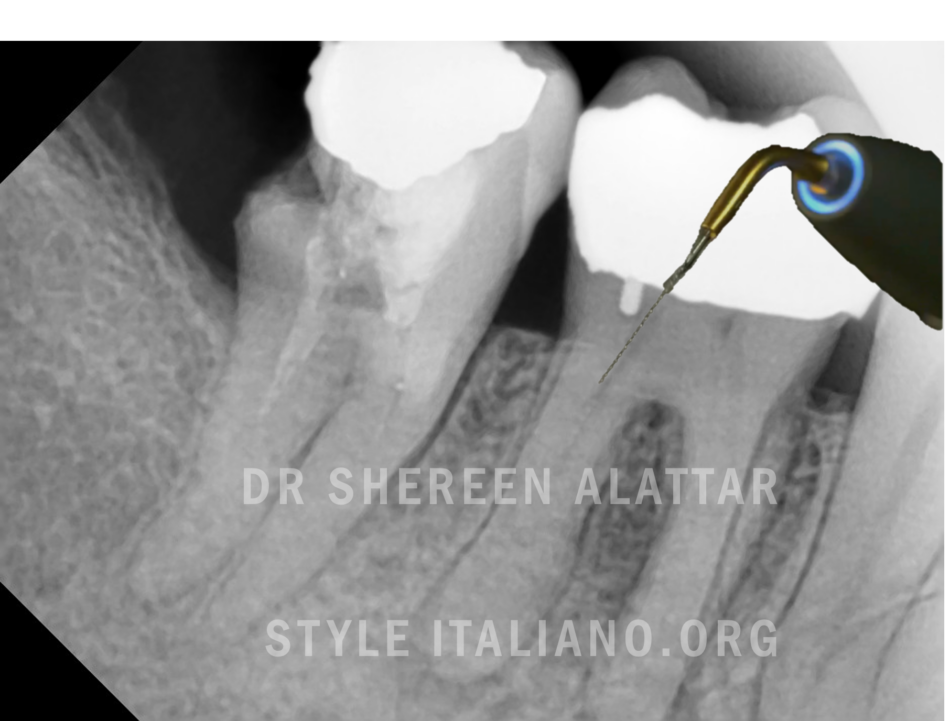 Clinical Tips for Managing Calcified Canals – endoville.com