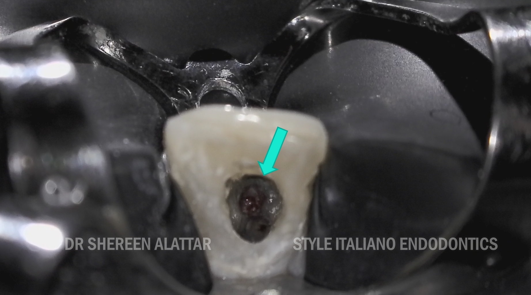 Root perforations: from breakdown to breakthrough – endoville.com