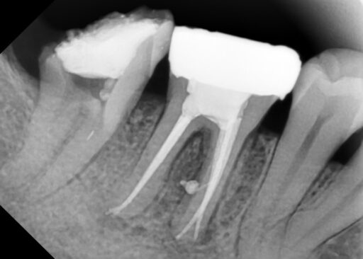 Clinical Tips for Managing Calcified Canals – endoville.com